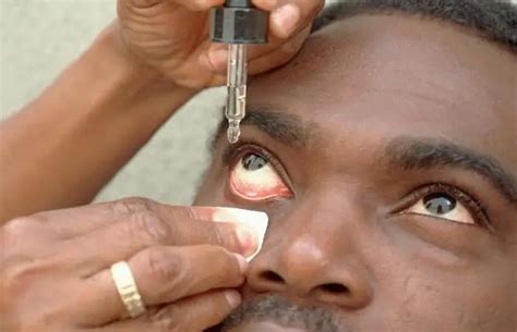 Angular Conjunctivitis Description Of Symptoms With Photos Causes Treatment And Prevention