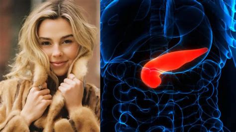 Sydney Towle Shares Rare Bile Duct Cancer Update Early Symptoms