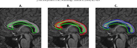 Figure 1 From Reliability Of Measuring Regional Callosal Atrophy In