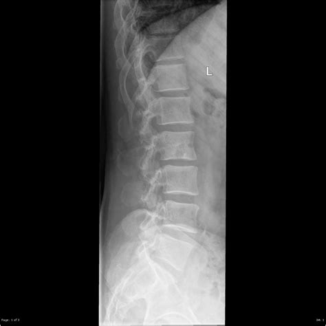 Osteomyelitis X Ray Spine
