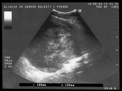 Successful Pregnancy Outcome In A Woman With Large Uterine Intramural