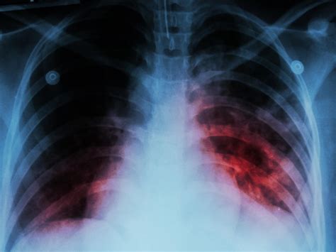 Tuberculosis Se Propaga En El Mundo