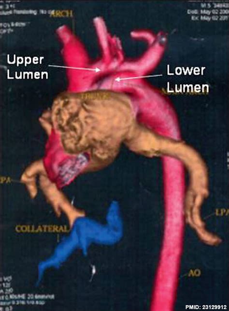 Cardiovascular System Patent Ductus Arteriosus Embryology