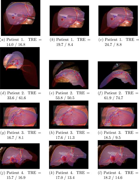Figure 9 From Automatic 3d2d Deformable Registration In Minimally Invasive Liver Resection