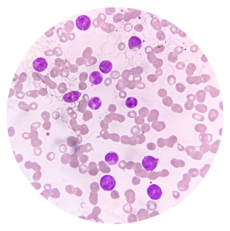 Premium Photo Acute Myeloid Leukemia Aml Cells Analysed By Light Microscope Micrograph 200x