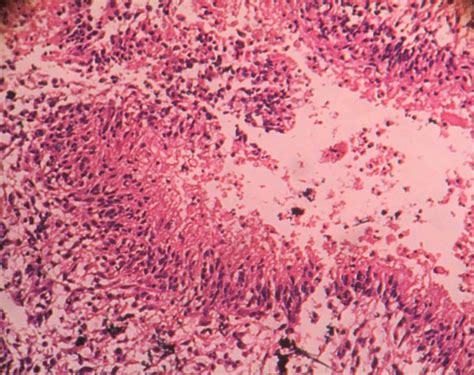 Glioblastoma Histopathologyguru