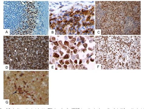 Figure 1 From Immunophenotyping Of Diffuse Large B Cell Lymphoma DLBCL Defines Multiple Sub