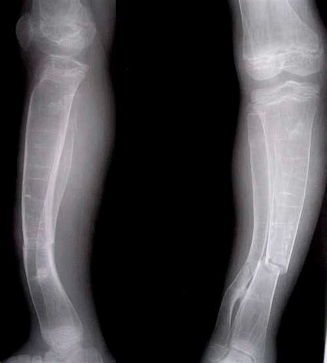 Fluoride Is Poisonous Fluorosis In The Skeleton