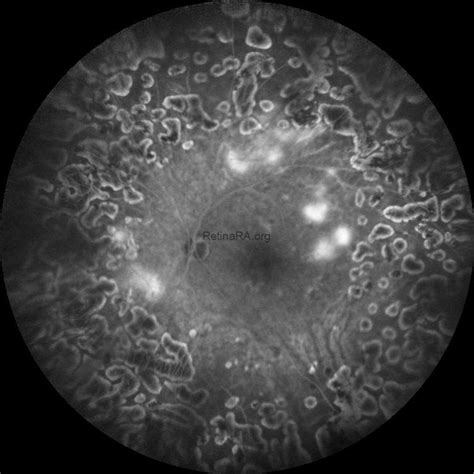 Multimodal Imaging Of Retinal Neovascularization Secondary To