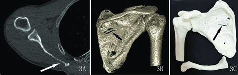 A 58 Year Old Man With A Scapula Body Linear Fracture Underwent An Download Scientific Diagram