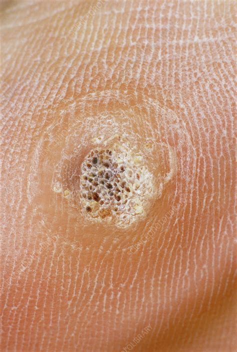 Verruca Stock Image M2900034 Science Photo Library