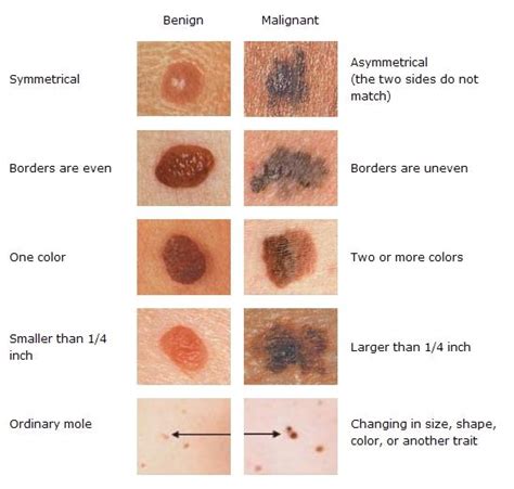 Cancerous Mole Vs Normal Mole When To See A Dermatologist For Skin