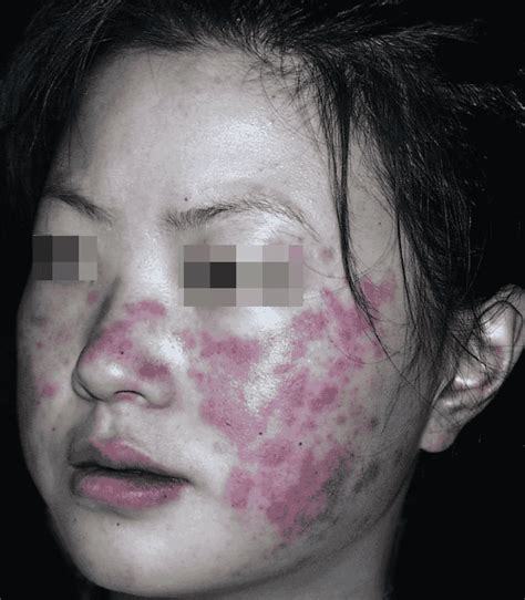 （科普）什么是系统性红斑狼疮？