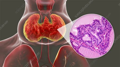 Toxic Goitre Of Thyroid Gland 3d Illustration Stock Image F042