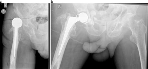 A 91year Old Male With Dilocated Ets Hemiarthroplasty B Revision To Download Scientific