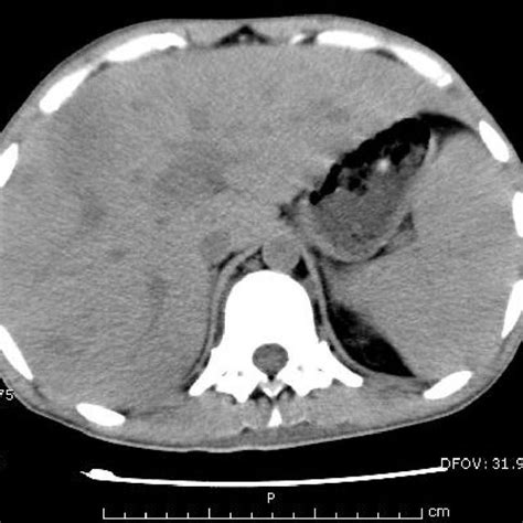 Marsh Oberhuber Classification Of Celiac Disease Download Table