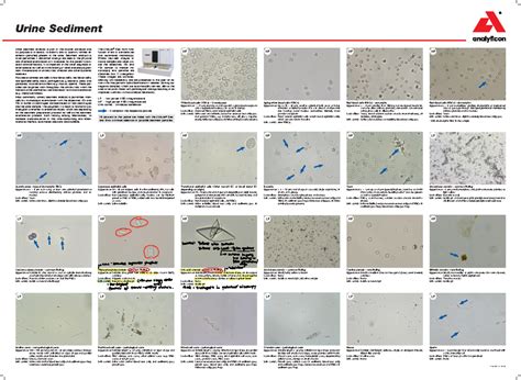 Urinalysis Artifacts Urine Sediment Calcium Oxalate Crystals Common