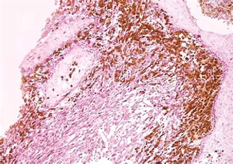 Photomicrograph Shows A Polypoidal Growth Composed Of Sheets Of Oval To Download Scientific