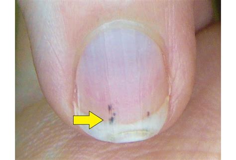 Fingernail And Toenail Abnormalities Nail The Diagnosis