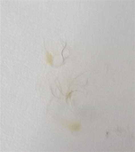 Bunch Of Small Hair Inside Pimple Gunk R Popping