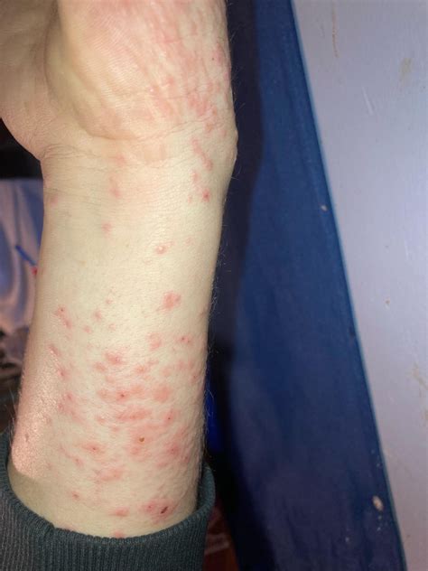 Allergic Reaction To Fiberglass Insulation Or What Is This Rash R