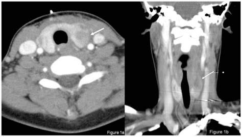 Thyroid Abscess As A Complication Of Bacterial Throat Infection