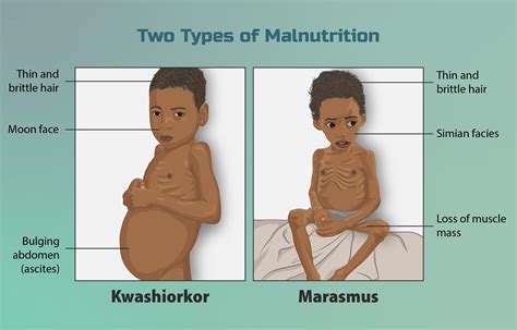 6 Fuvest Sp 2003 O Kwashiorkor E O Marasmo São Doenças Infantis Por
