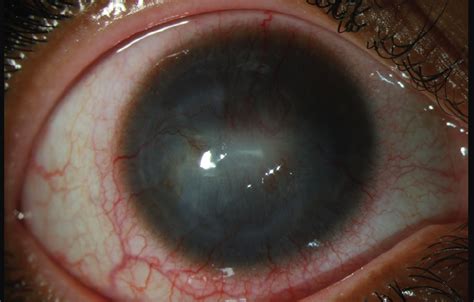 Acanthamoeba Keratitis
