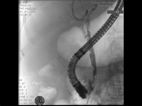 Video Mario Gagliardi Md On Linkedin Spyglass Ercp Spyglass
