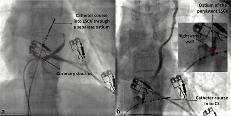 A Coronary Sinus Cs Venogram In Postero Anterior View Demonstrating