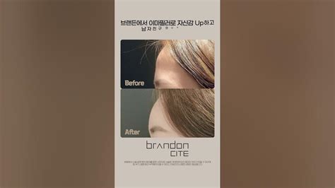 푹 꺼진 이마에 자연스럽게 채워지는 볼륨 이마필러 전후 차이 Youtube