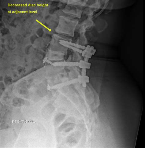 Lumbar Spine Anatomy Xray Lumbar Spine Anatomy Xray