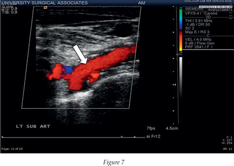 Figure 7 From Duplex Ultrasound Diagnosis Of An Arteriovenous Fistula