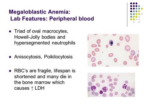 Mlab Hematology Keri Brophy Martinez Macrocytic Anemias Ppt Download