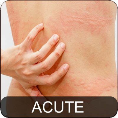 Differential Diagnosis Of Common Dermatologic Disorders Part Acute