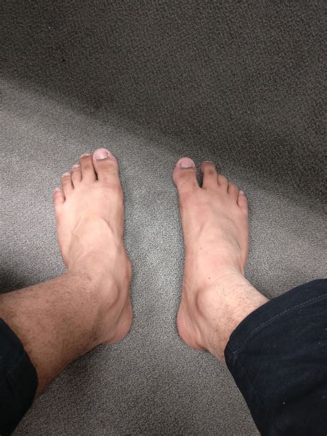 Accessory Navicular Fileacessory Navicular Bone 2 Wikimedia