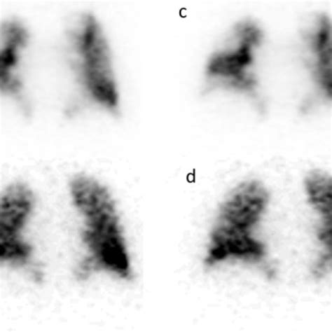 V Q Lung Spect Comparison Between Ss A Perfusion B Ventilation And Download Scientific
