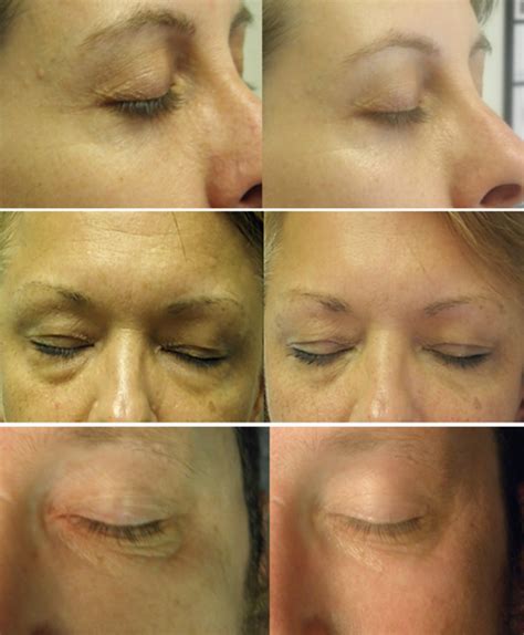Poly Red Light Therapy Skin Rejuvenation Is Here