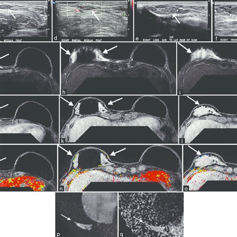 Case 2 46 Year Old Female With Bilateral Prophylactic Mastectomies And