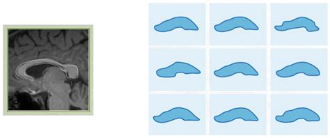 Medical Image Segmentation Active Shape Model
