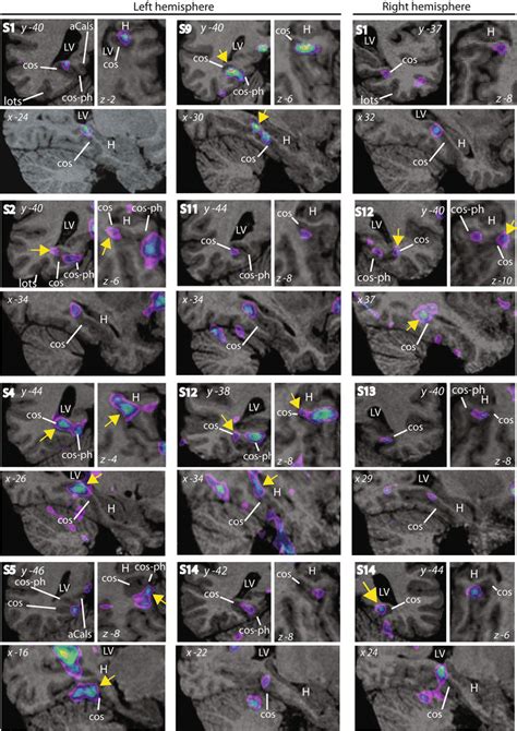 Activation Peaks Along The Posterior Parahippocampal Cortex Download Scientific Diagram