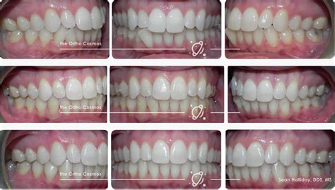 Effective Use Of Additional Aligners The Ortho Cosmos