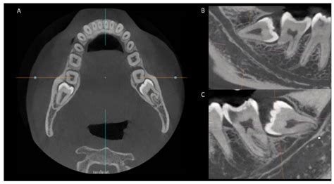 Cbct Scans Showing The Anatomical Relationship Between The Root Apex Of Download Scientific