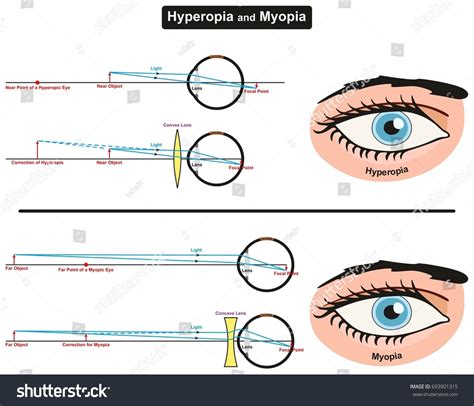 Hyperopia Myopia Infographic Diagram Showing Comparison เวกเตอร์สต็อก