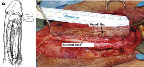 Genital Flaps For Anterior Urethral Reconstruction