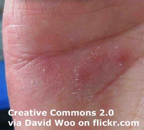 Breaking News English Speed Reading 100 Wpm Eczema And Itchiness
