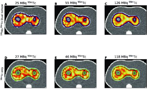 4 Shows The Axial View Of Six Phantom Spectct Scans With The Healthy