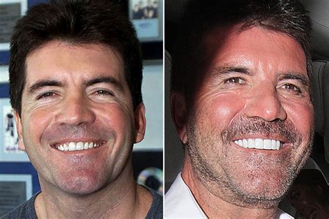 As Simon Cowell Shows Off Gleaming Teeth Other Celebs Whove
