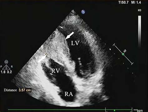 A Noteworthy Electrocardiogram Circulation
