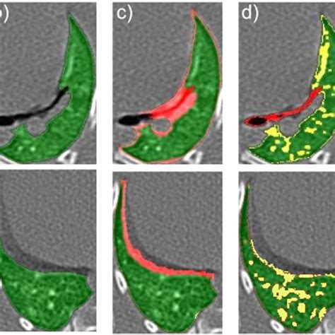 Sample Lung Segmentations On A Representative Slice A Corresponding